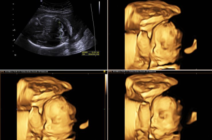 Ultrasound Scan – 3D & 4D - A-One Ultrasound & Eye Care